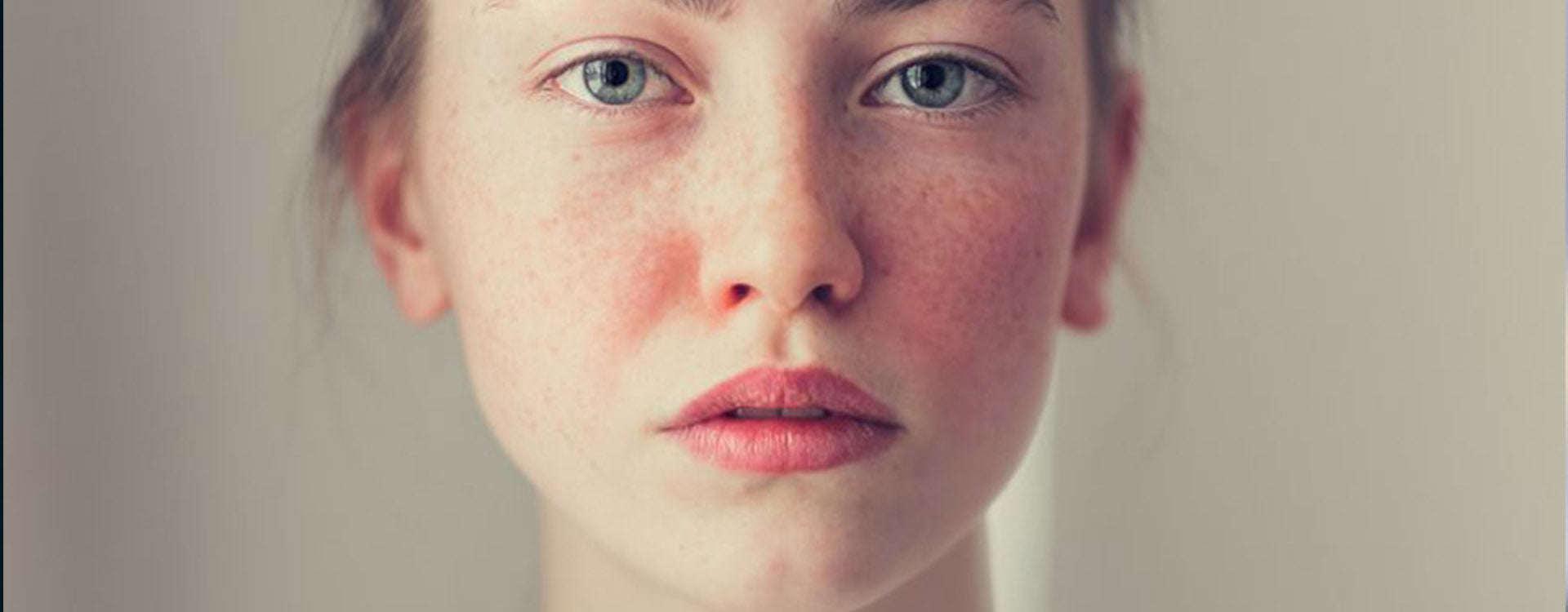 Acné rosacée ou couperose, comment traiter ces rougeurs ? – BIOSME ...